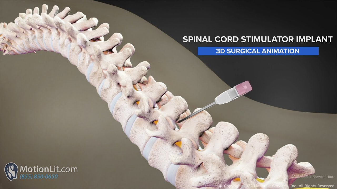3D Surgery Animation of Spine Injury Portrays Spinal Cord Stimulator ...