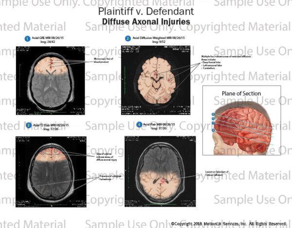 Diffuse Axonal Injuries - MotionLit
