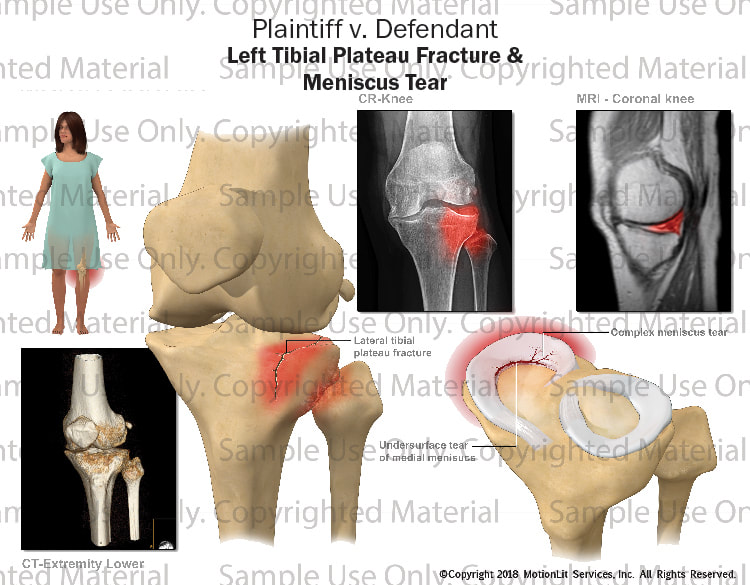 Left Tibial Plateau Fracture Meniscus Tear - MotionLit