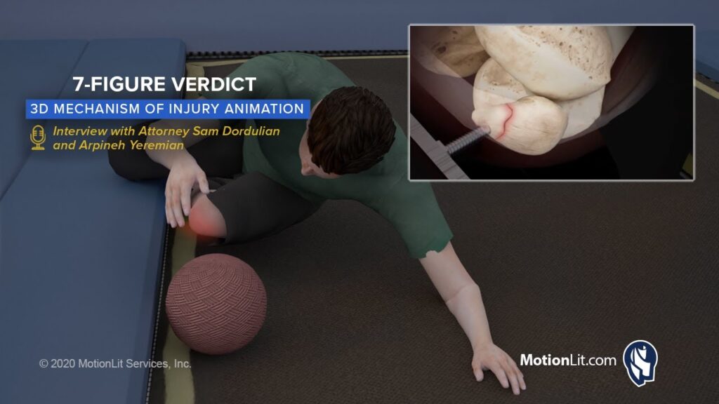 Steven & Justin Effres Obtain a $1.6 Million Settlement with MotionLit’s 3D Surgery & Accident ...