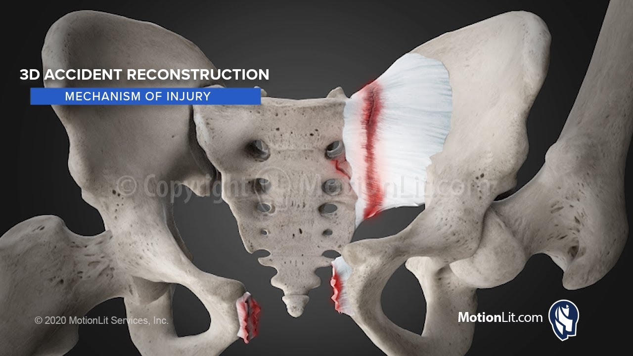3D Injury Reconstruction Animation: Construction Worker Injured On-Site ...