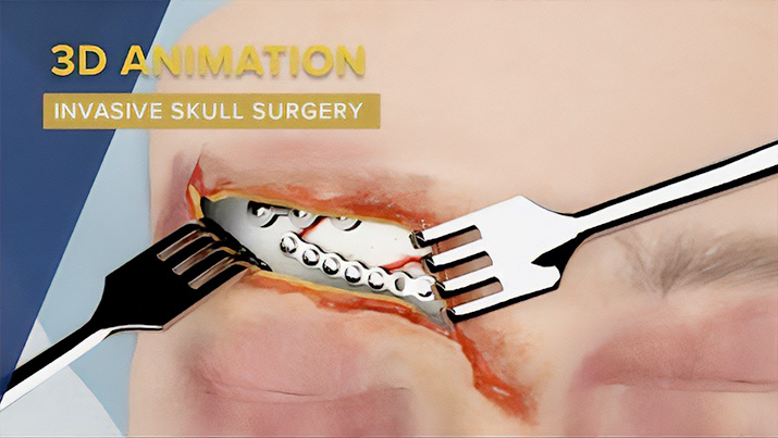 3D Animation Used To Display Invasive ORIF Skull Surgery - MotionLit