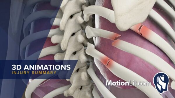 3D Surgery Animation of Spine Injury Portrays Spinal Cord Stimulator ...