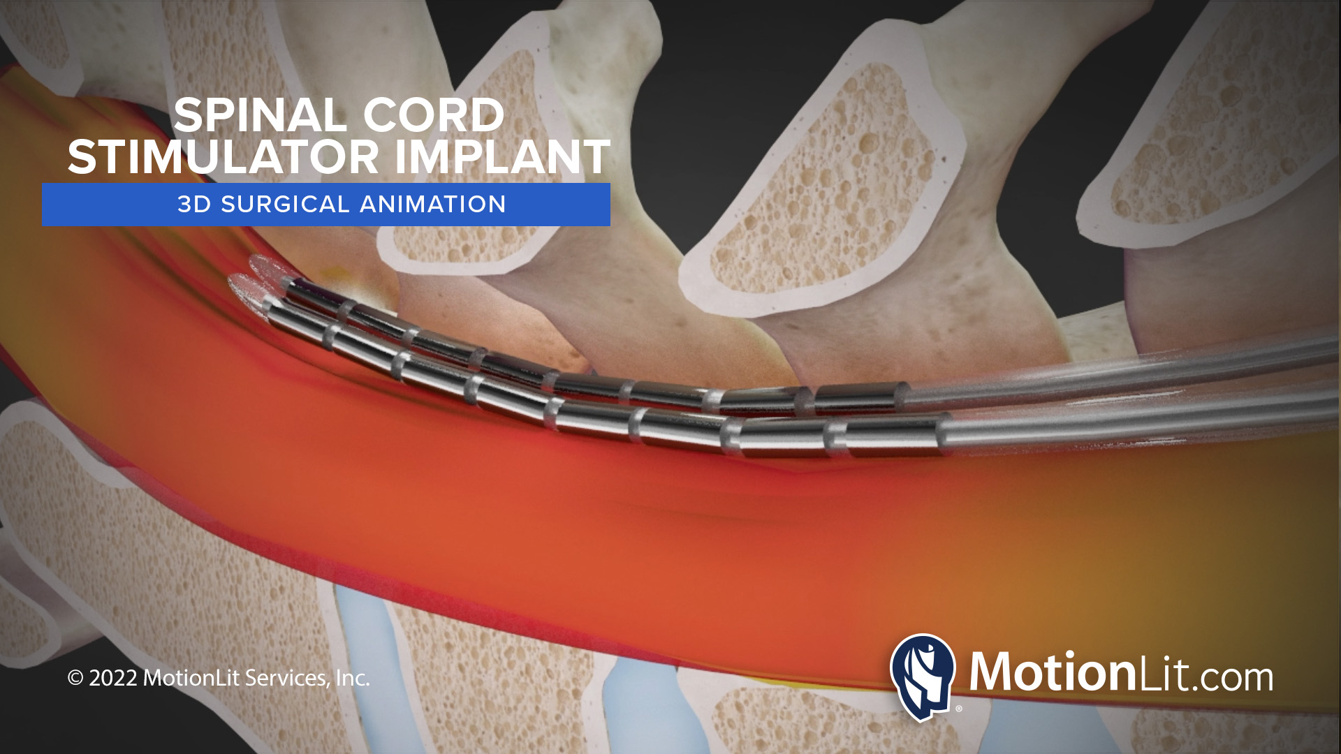 Help Jurors Understand Damages with 3D Surgery Animation