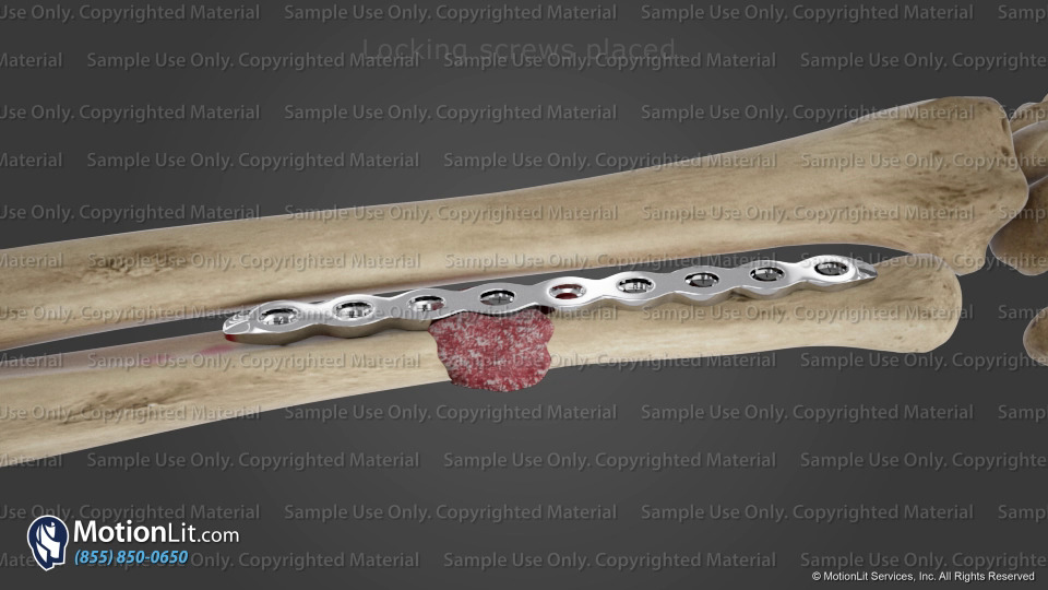 Hardware Removal & Bone Graft - MotionLit