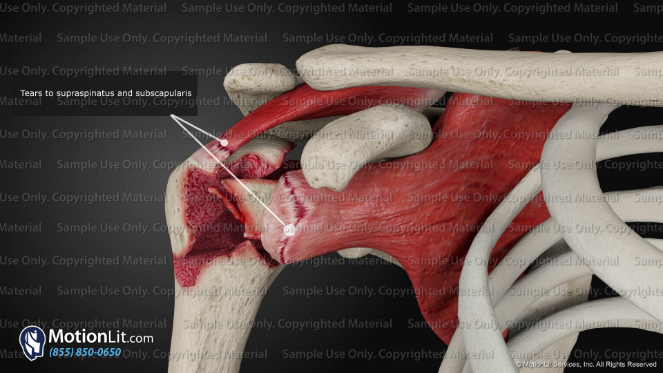 Depicting Complex Reverse Shoulder Replacement Surgery Utilizing 3D ...