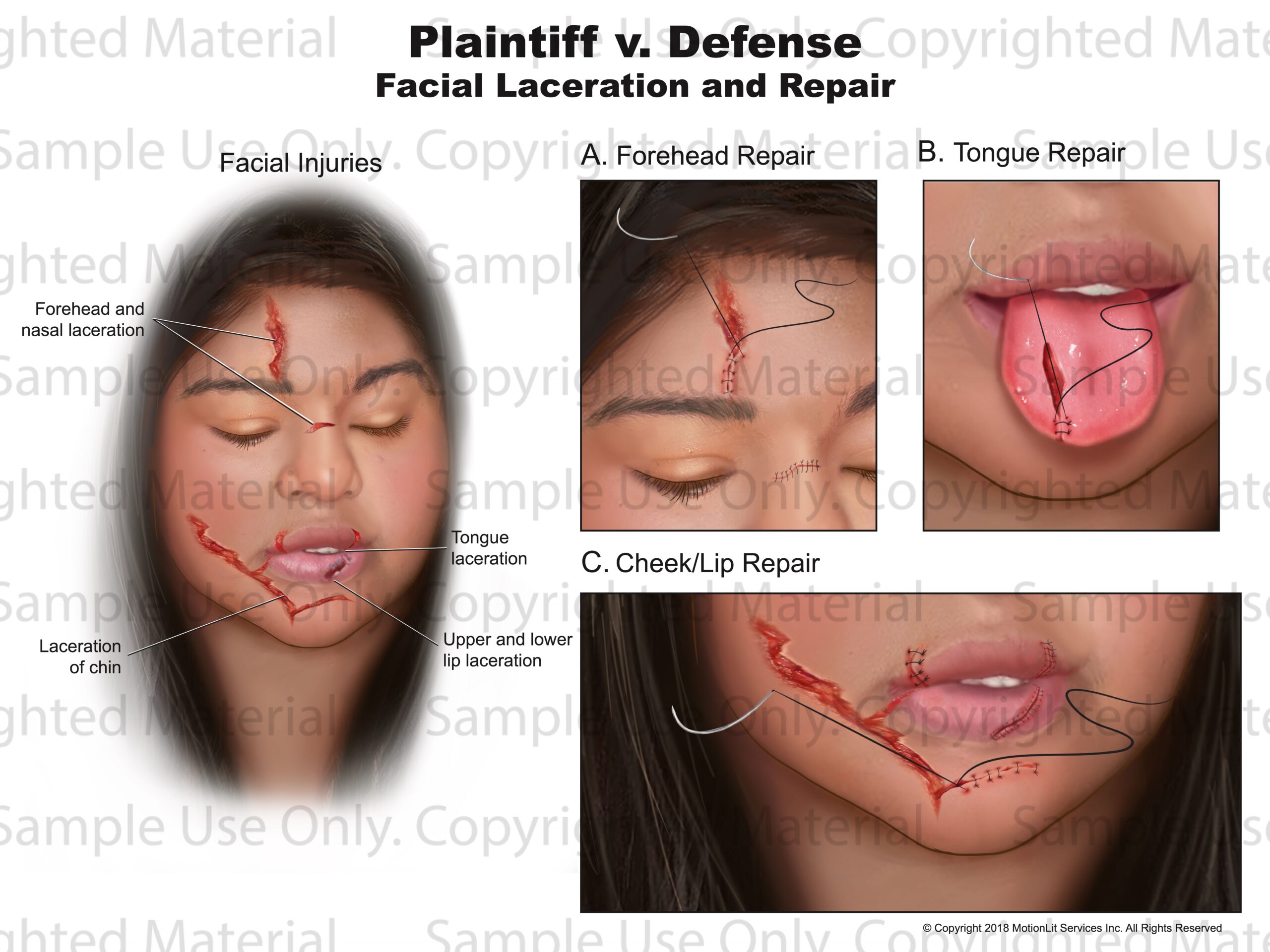 Facial Lacerations 1 MotionLit