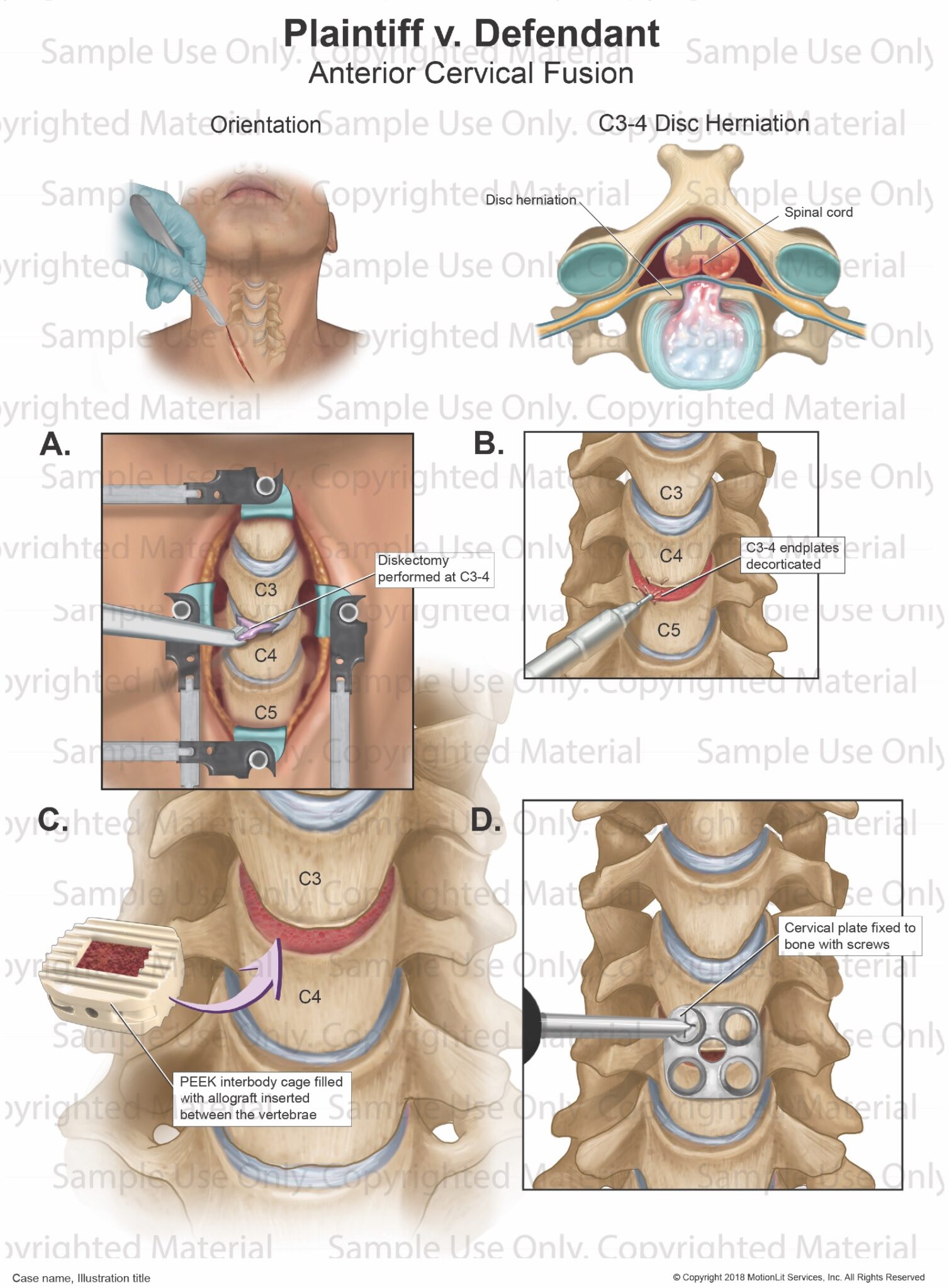 Anterior Cervical Fusion - MotionLit