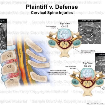 Cervical Disc Replacement C5-C6 - MotionLit