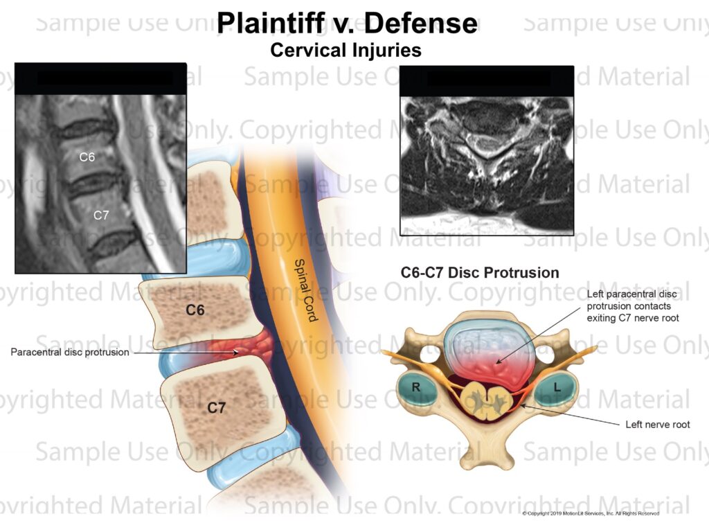 Disc Injuries C6-C7 - MotionLit