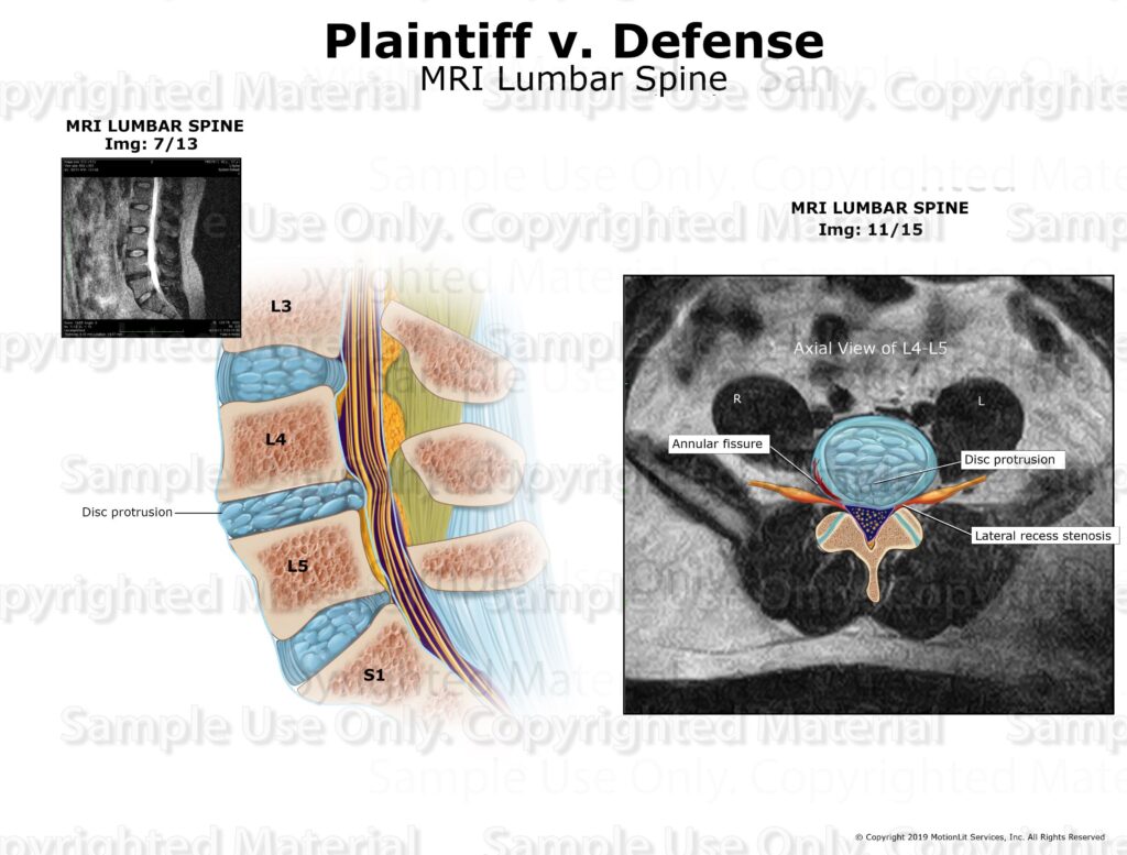 Lumbar MRI Interpretation - MotionLit