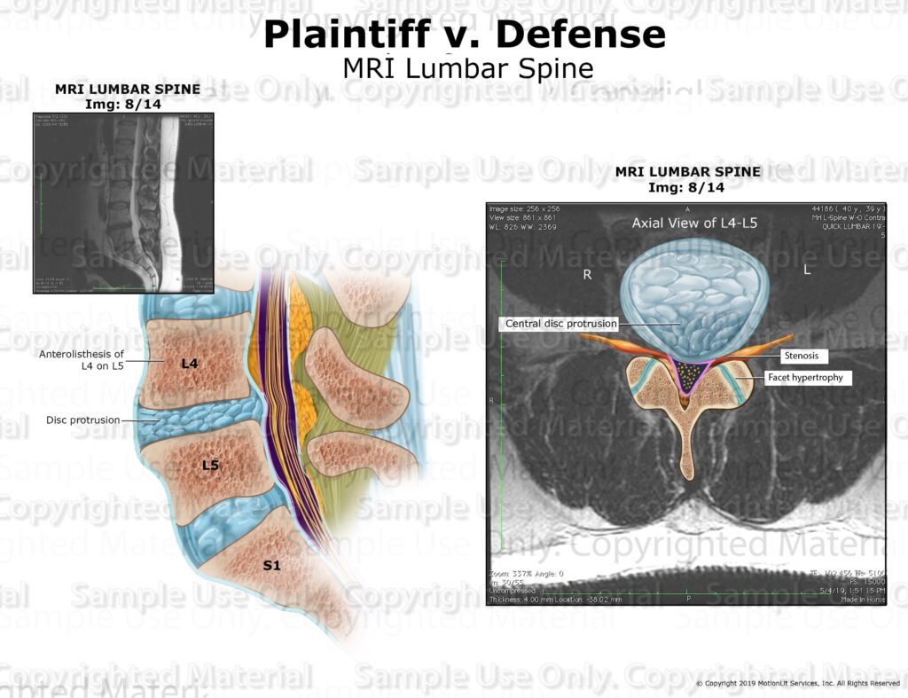 MRI Interpretation L4-L5 - MotionLit MRI Interpretation L4-L5 - MotionLit