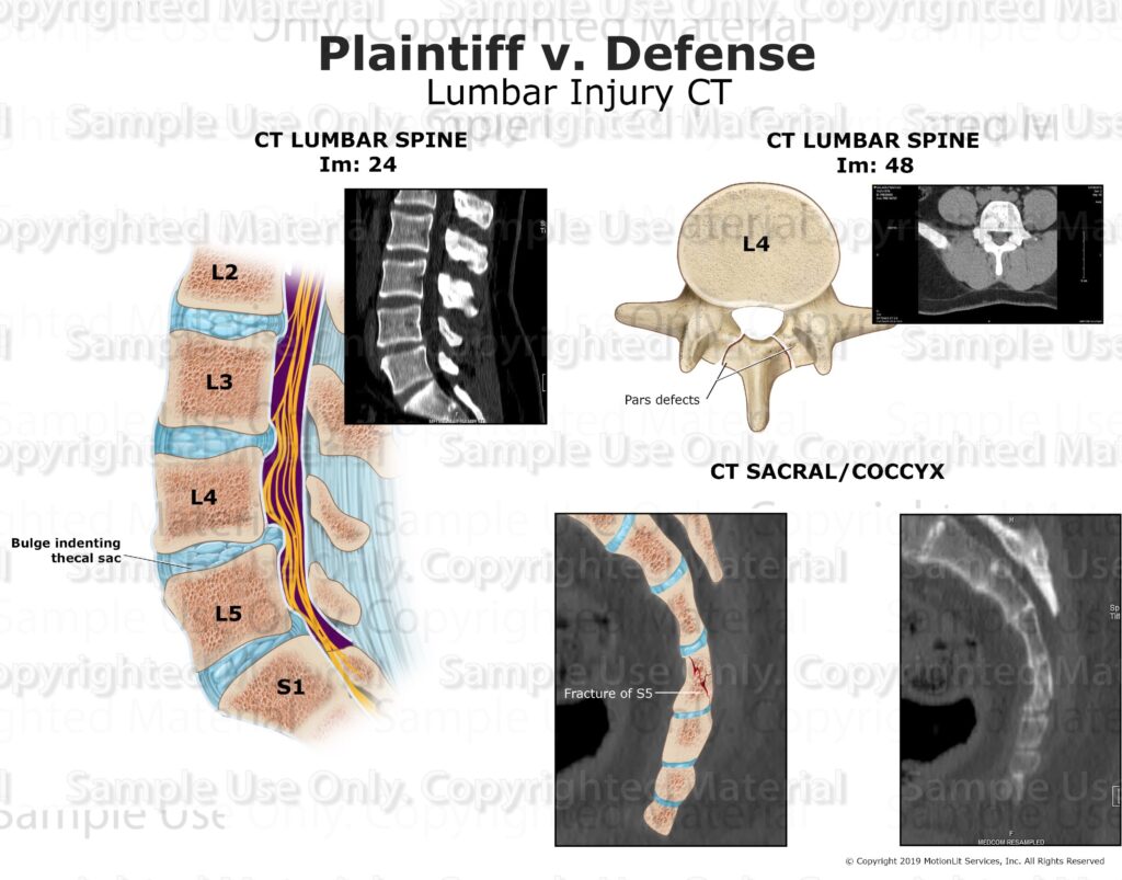 Pars Fracture Sacral Fracture - MotionLit