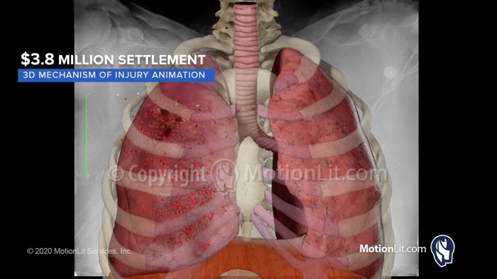 Medical Procedure Animation Visualizes Posterior Lumbar Microdiscectomy ...