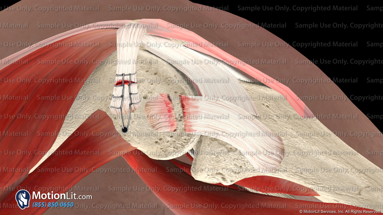 L ACL Reconstruction - MotionLit